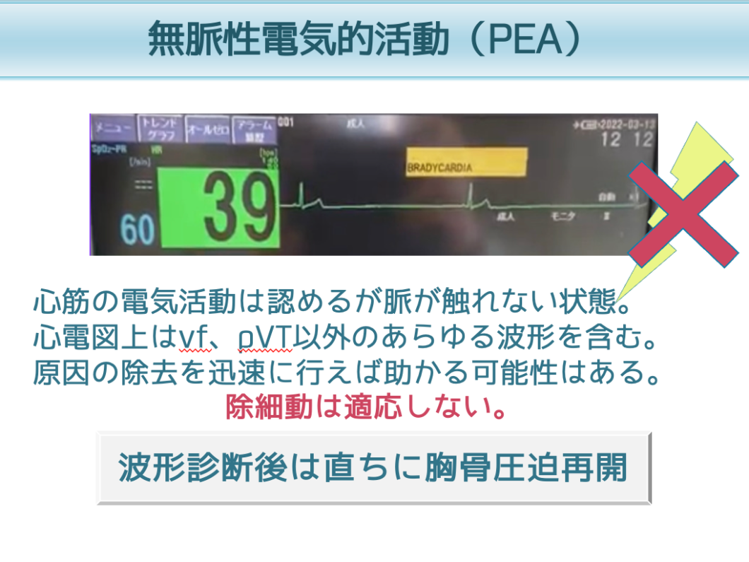 【図解】PEA（無脈性電気活動）の急変対応｜原因「5H5T」の覚え方と看護師の役割 | 急変対応.net